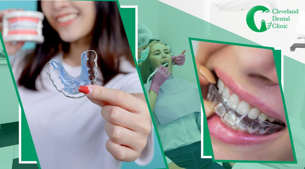 Dental Invisalign: Everything you need to know? | Blog