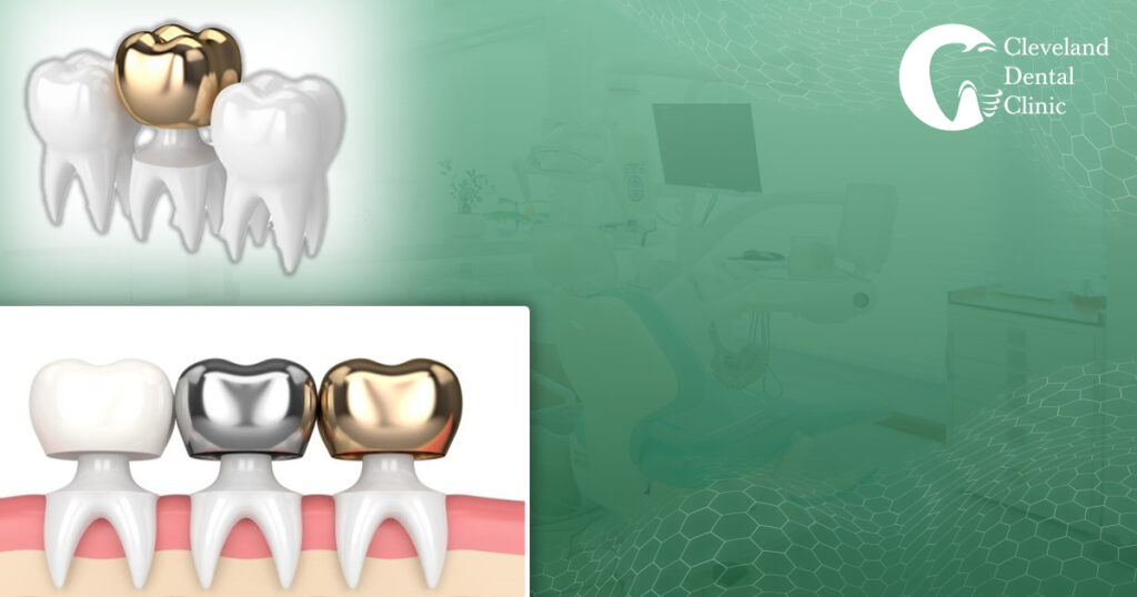 Everything you need to know about dental crowns | Blog