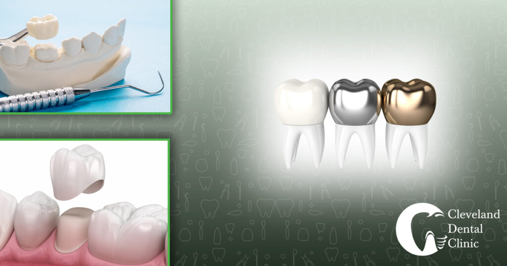 How are same day crowns made? | Blog | Dental Implants