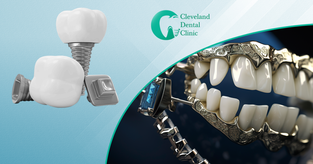 Full Metal Crown: Pros and Cons of Full Metal Crown | Blog