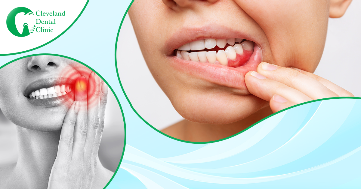 The Common Causes Of Tooth Pain Cleveland Dental Clinic